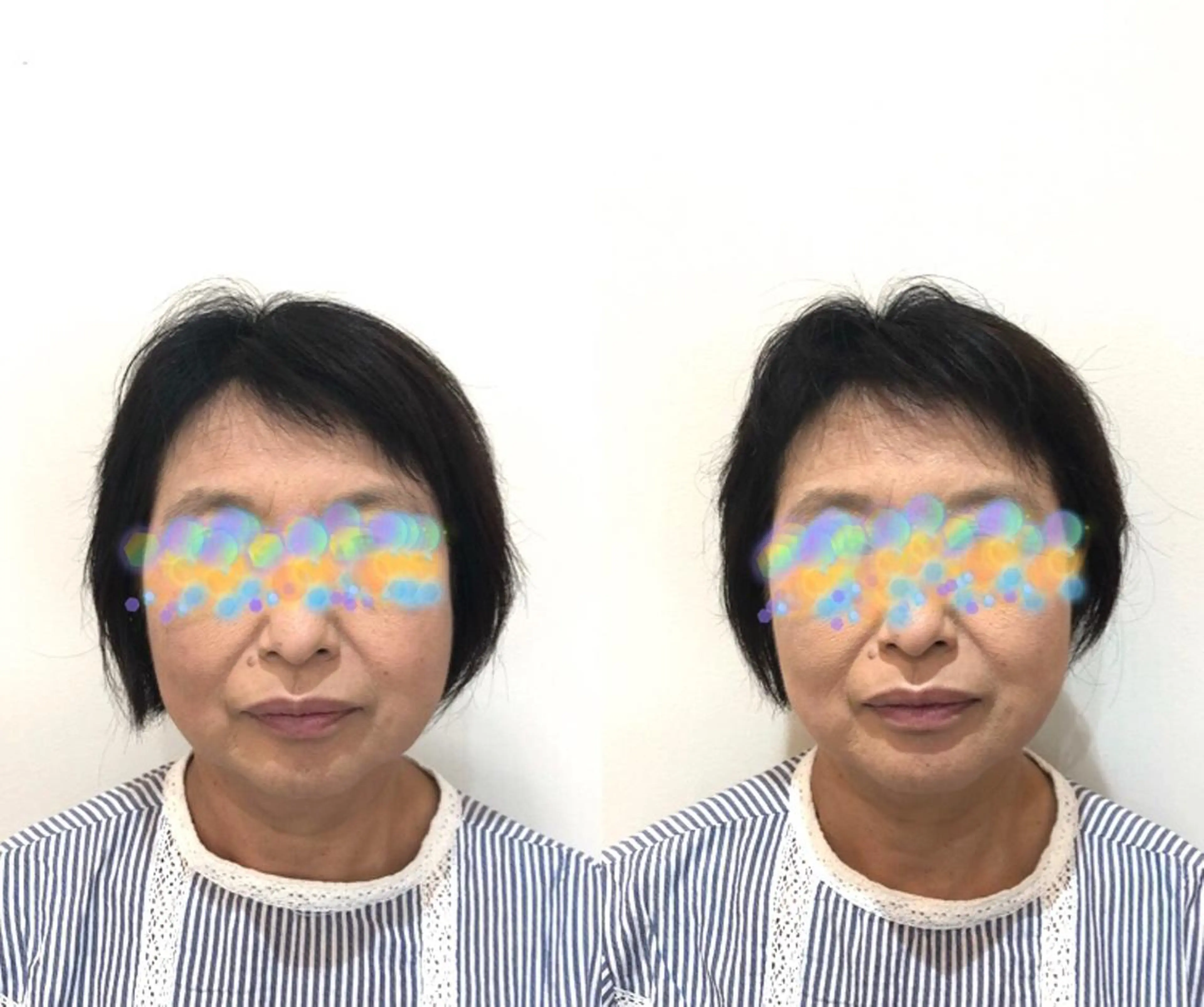 長年のむくみ・筋肉の衰えによりブルドッグ顔に 老廃物を流しやすくしてあげて、筋肉を呼び起こしてあげま｜Attract所属・江頭 聖子のエステ ...